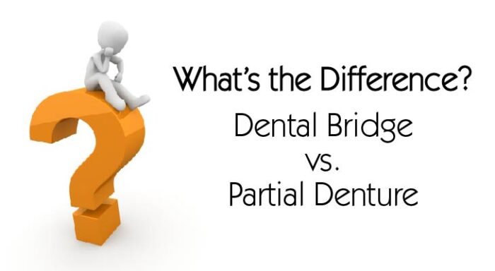 What’s the Difference Between a Dental Bridge & a Partial Denture ...